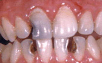 What causes tooth decay or cavities. | Northpointe Smiles | Tomball, TX ...